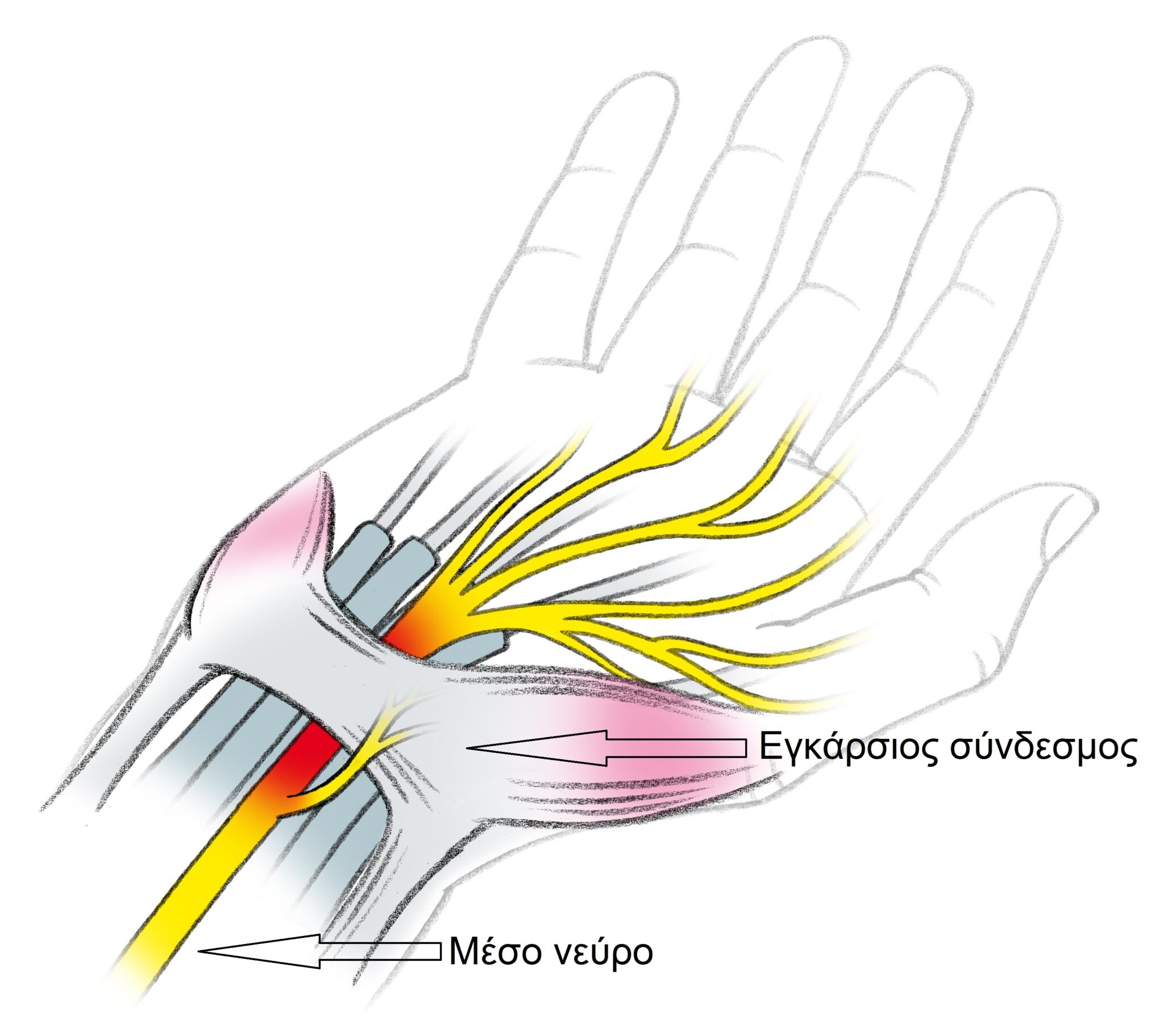 Σύνδρομο καρπιαίου σωλήνα | Ορθοπεδικός Χαλκίδα | Γ. Ροντογιάννης